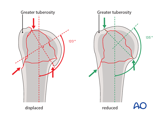 ORIF - Plate fixation for 4-Part, marked displacement, intact articular ...