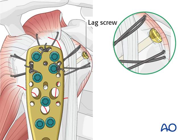 ORIF - Plate fixation for 4-Part, marked displacement, intact articular ...