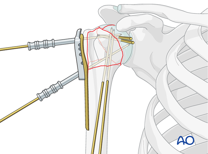 ORIF - Plate fixation for 4-Part, dislocation, fragmentary metaphyseal ...