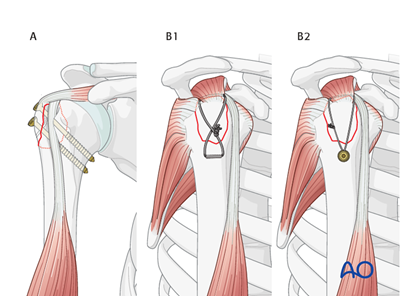 ORIF - Screw or suture fixation for Extraarticular 2-part, greater ...