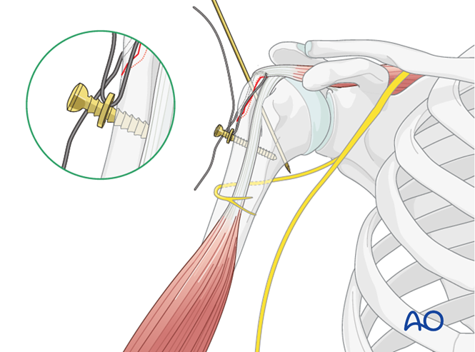 ORIF - Screw or suture fixation for Extraarticular 2-part, greater ...