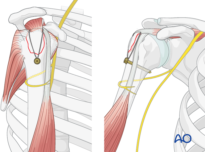 ORIF - Screw or suture fixation for Extraarticular 2-part, greater ...