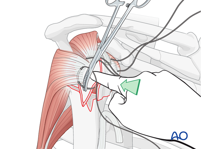 Hemiarthroplasty for Extraarticular 3-part, surgical neck and ...