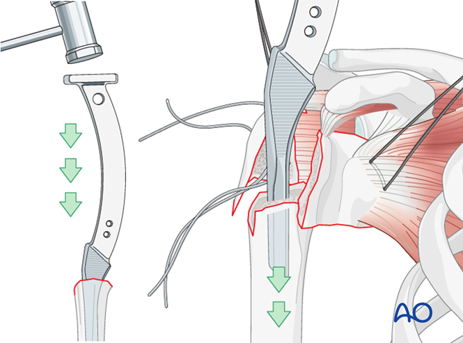 Hemiarthroplasty for Extraarticular 3-part, surgical neck and ...