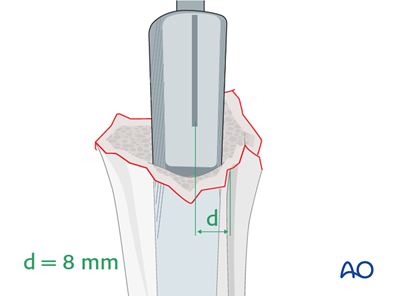 Hemiarthroplasty for Extraarticular 3-part, surgical neck and ...