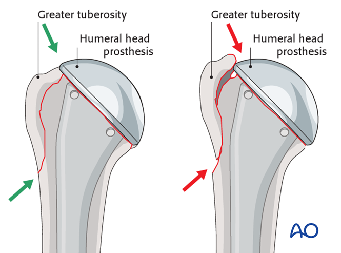 Hemiarthroplasty for Extraarticular 3-part, surgical neck and ...