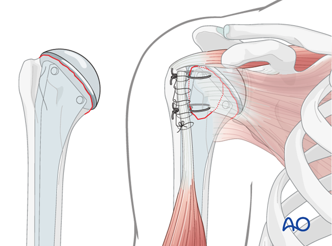 Hemiarthroplasty for Isolated anatomical neck, dislocation