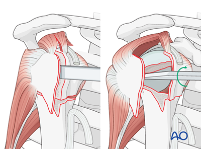 Reverse arthroplasty for 4-Part, marked displacement, fragmentary ...