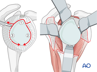 Reverse arthroplasty for Extraarticular 2-part, surgical neck, impaction