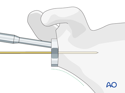 Reverse arthroplasty for Extraarticular 2-part, surgical neck, impaction