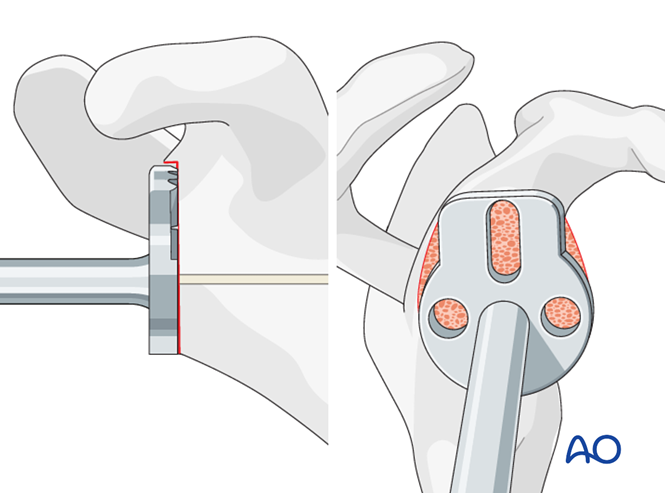 Reverse arthroplasty for Extraarticular 2-part, surgical neck, impaction