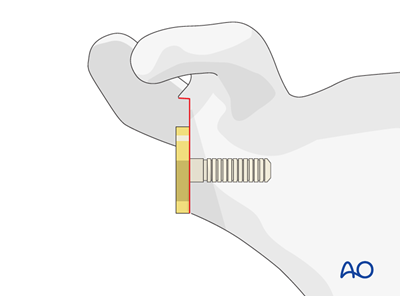 Reverse arthroplasty for Extraarticular 2-part, surgical neck, impaction