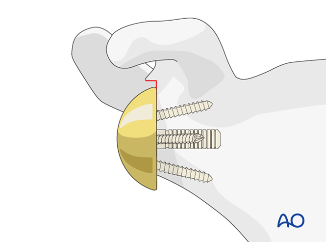 Reverse arthroplasty for Extraarticular 2-part, surgical neck, impaction