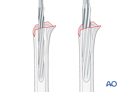 Reverse arthroplasty for 4-Part, dislocation, simple metaphyseal ...