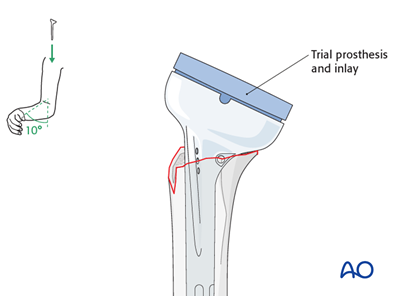 Reverse arthroplasty for Extraarticular 2-part, surgical neck, impaction