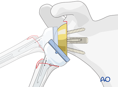 Reverse arthroplasty for Extraarticular 2-part, surgical neck, impaction
