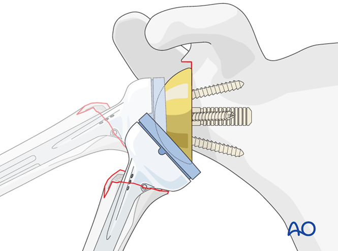 Reverse arthroplasty for Extraarticular 2-part, surgical neck, impaction