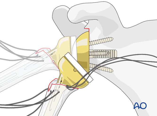 Reverse arthroplasty for Extraarticular 2-part, surgical neck, impaction