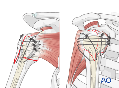 Reverse arthroplasty for 4-Part, dislocation, simple metaphyseal ...