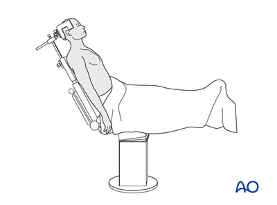 Nailing (straight nail) for Extraarticular 2-part, surgical neck, impaction