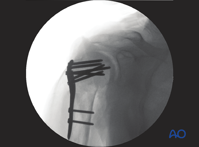 Intraoperative imaging of the proximal humerus