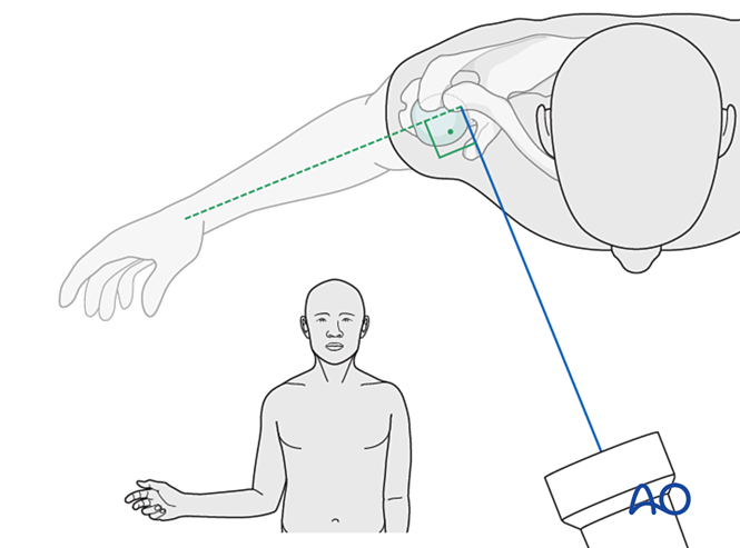 Intraoperative imaging of the proximal humerus
