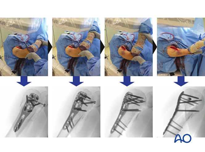 Intraoperative imaging of the proximal humerus