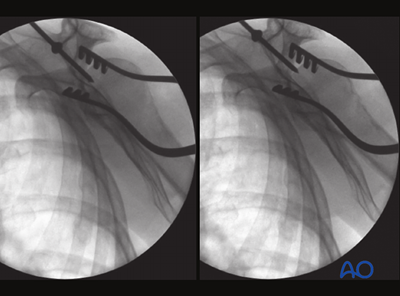 Intraoperative imaging of the proximal humerus