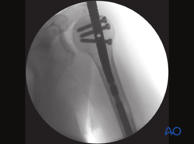 Intraoperative imaging of the proximal humerus