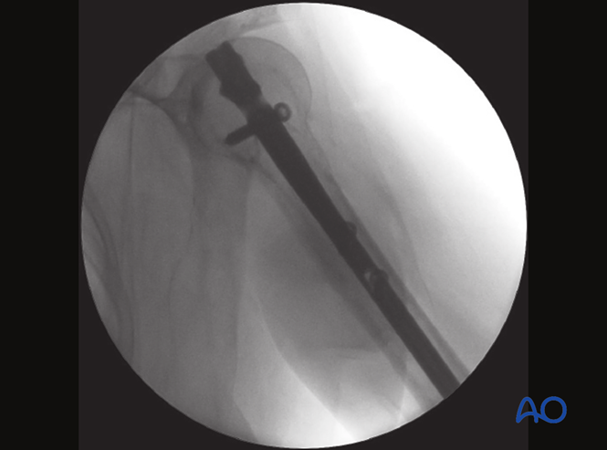 Intraoperative imaging of the proximal humerus