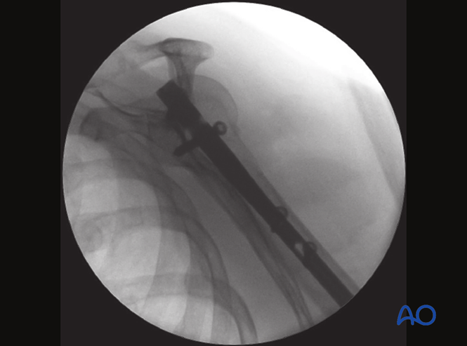 Intraoperative imaging of the proximal humerus