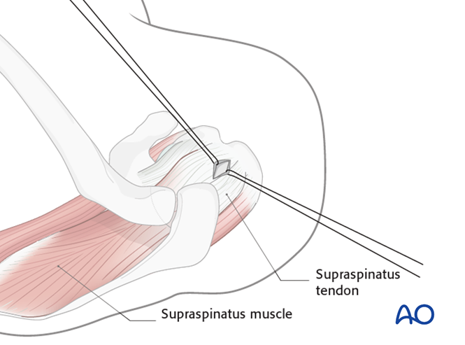 Anterolateral transdeltoid approach to the humerus for antegrade nailing