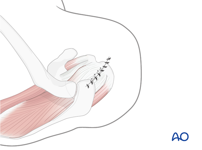 Anterolateral transdeltoid approach to the humerus for antegrade nailing