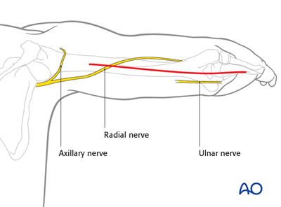 Posterior triceps-sparing approach (triceps-on) to the humeral shaft