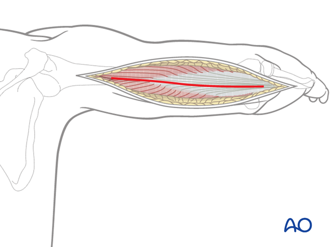 Posterior triceps-sparing approach (triceps-on) to the humeral shaft