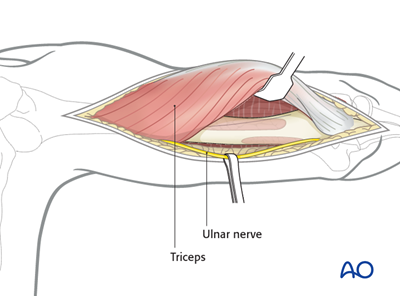 Posterior triceps-sparing approach (triceps-on) to the humeral shaft