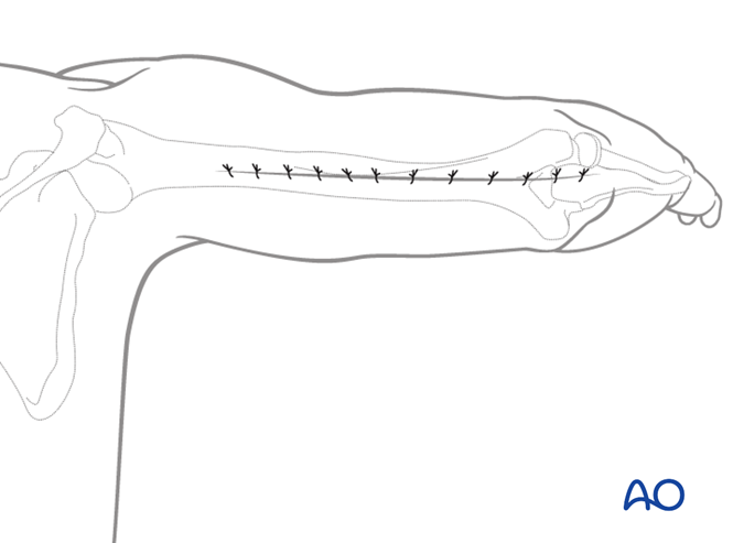 Posterior triceps-sparing approach (triceps-on) to the humeral shaft