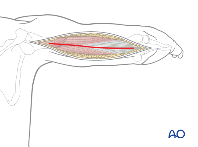 Posterior triceps-split approach to the humeral shaft