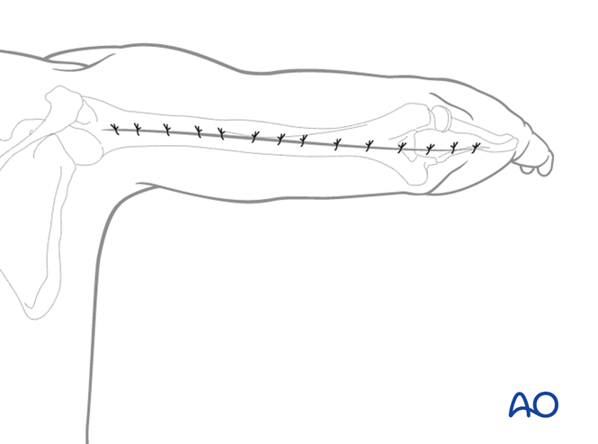Posterior triceps-split approach to the humeral shaft