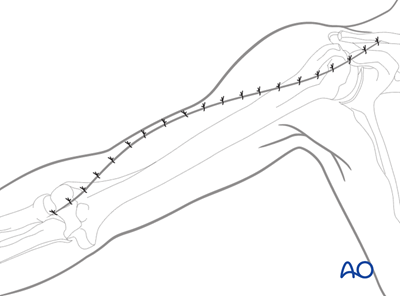 Extended deltopectoral approach to the humeral shaft