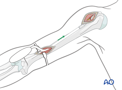 Limited approaches for anterior MIO of the humeral shaft