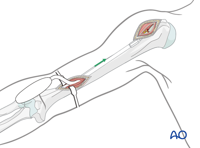 Limited approaches for anterior MIO of the humeral shaft