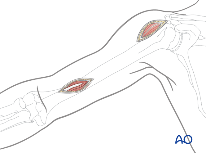 Limited approaches for anterior MIO of the humeral shaft