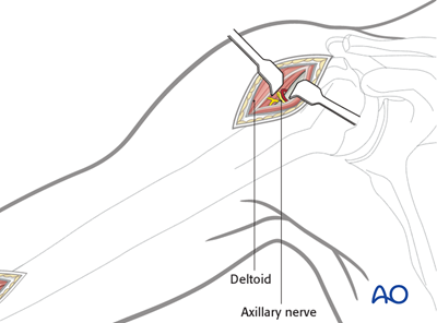 Limited approaches for anterior MIO of the humeral shaft