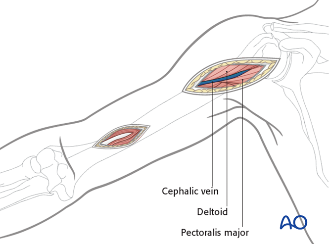 Limited approaches for anterior MIO of the humeral shaft