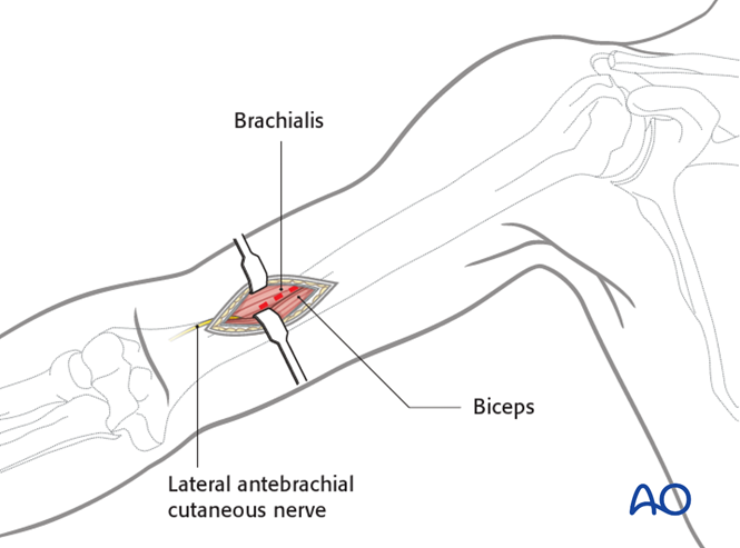 Limited approaches for anterior MIO of the humeral shaft
