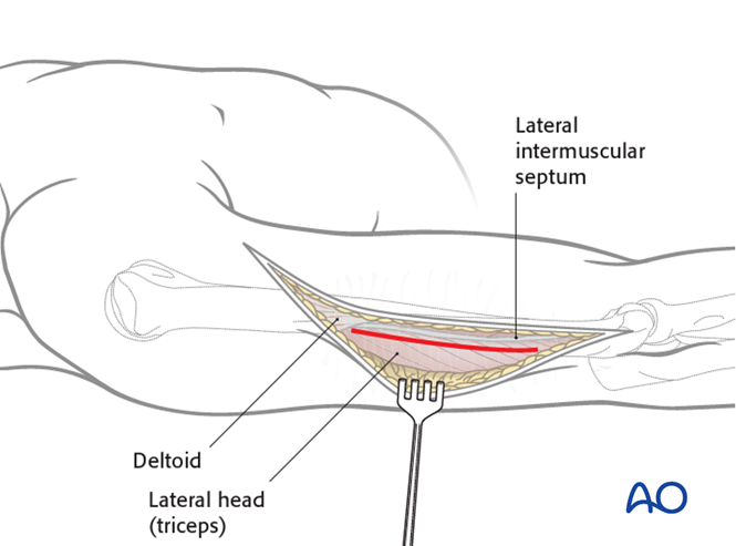 Lateral approach to the humeral shaft