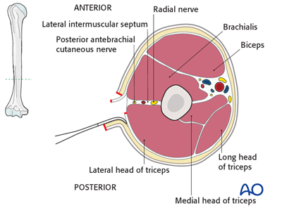 Lateral approach to the humeral shaft