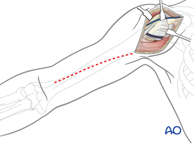 Extended deltopectoral approach to the humeral shaft