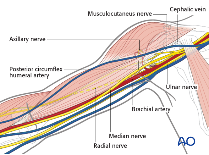 Extended deltopectoral approach to the humeral shaft